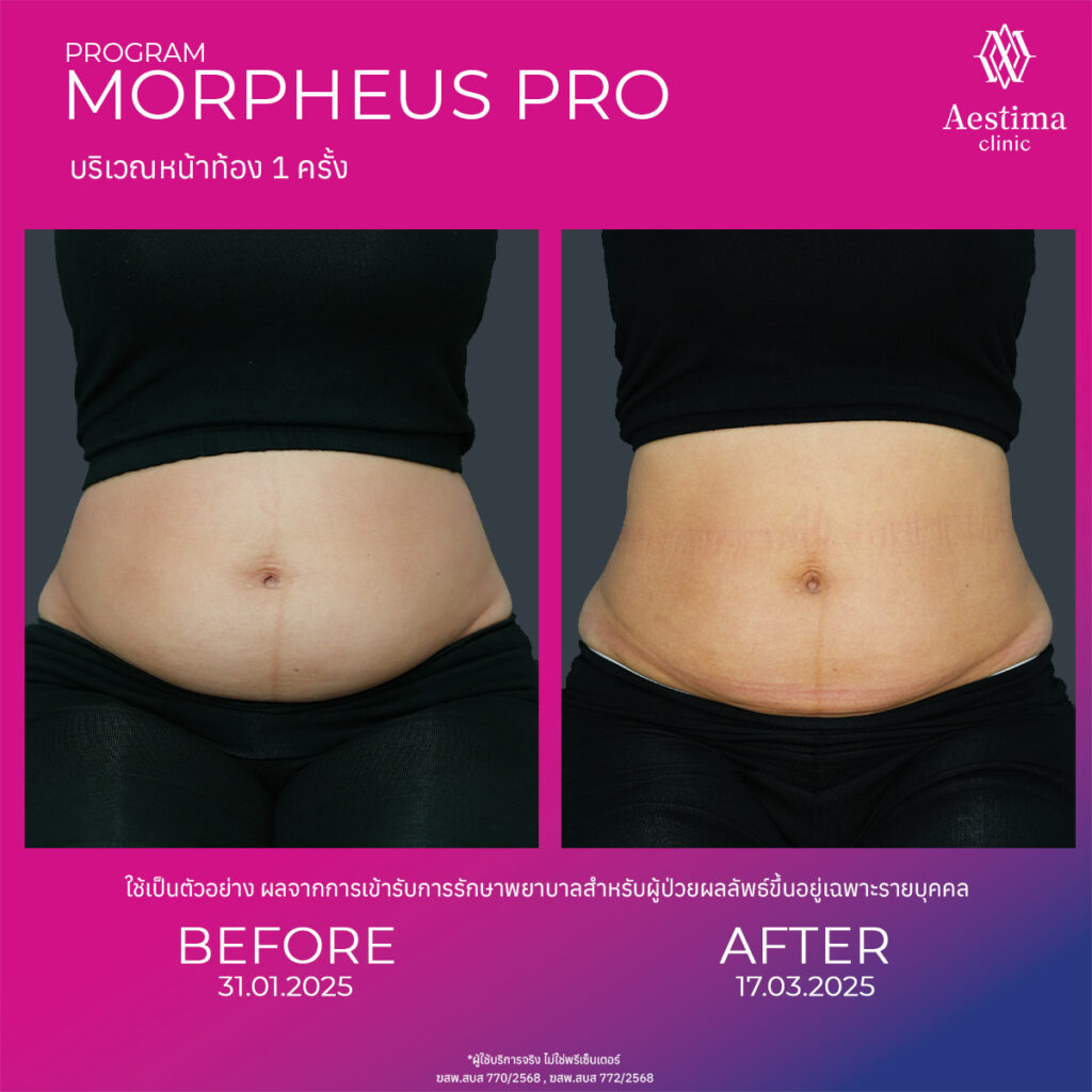 Program Morpheus Body คืออะไร ช่วยอะไร ทำบริเวณไหนได้บ้าง?
